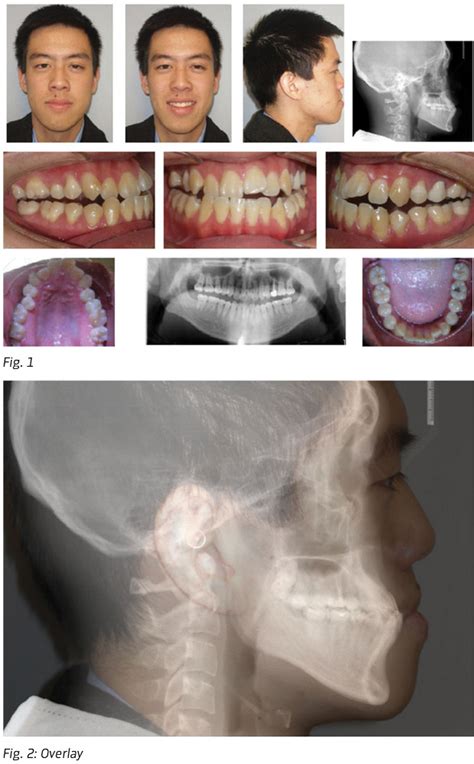 Class Iii Malocclusion Treated Non Surgically With Invisalign