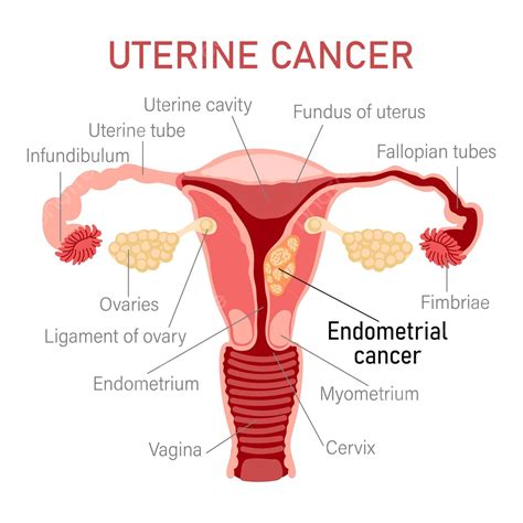 Infographic Banner On Gynecology Female Reproductive System Diseases