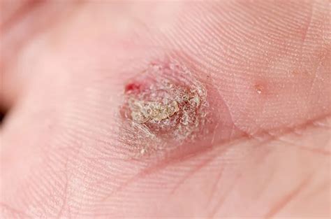Pyoderma Gangrenosum Bisa Ditangani Dengan 3 Metode Ini