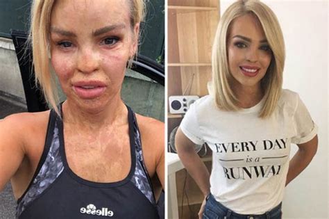 Katie Piper Acid Attack What Happened To The Strictly Come Dancing