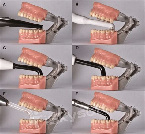 Lcu Tip Angulation And Ideal Positioning At Same Mouth Aperture Download Scientific Diagram