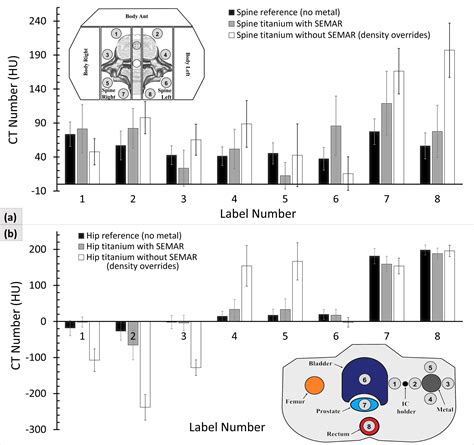 Radiotherapy Planning Of Spine And Pelvis Using Single Energy Metal Artifact Reduction Corrected