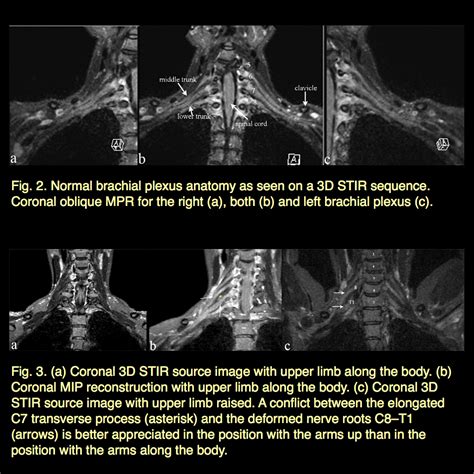 Mri Blog Brachial Plexus Mri Ii Ii