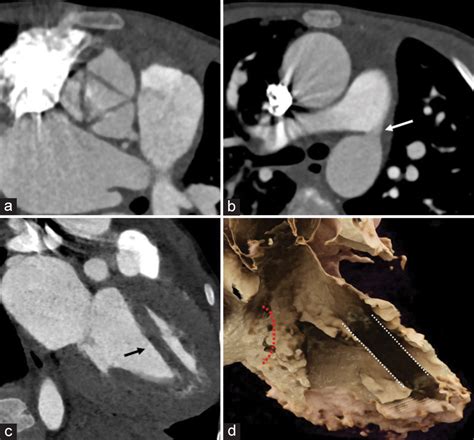 Left Ventricular False Tendons Unseen Or Overlooked Case Reports In
