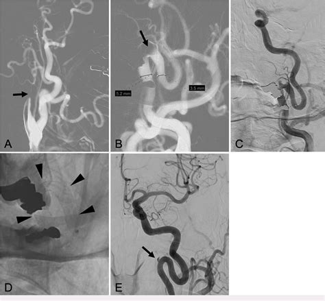 Figure 1 From Utility Of Pipeline Embolization Device For Emergency Recanalization Of A