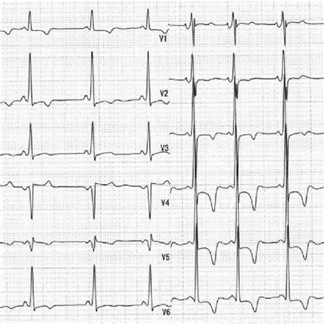 Electrocardiogram On Admission A Supraventricular Ectopy Short Pq