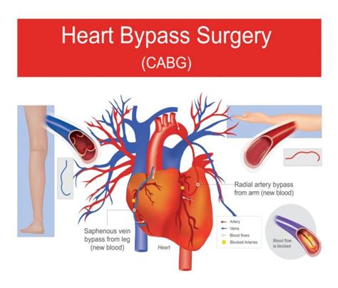 Heart Bypass Surgery Vector Id876508752 Heart 2 Heart Cardiac