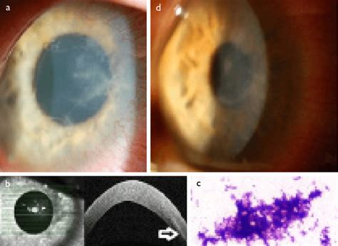 A Slit Lamp Examination Revealed Stromal And Perineural Infiltrates