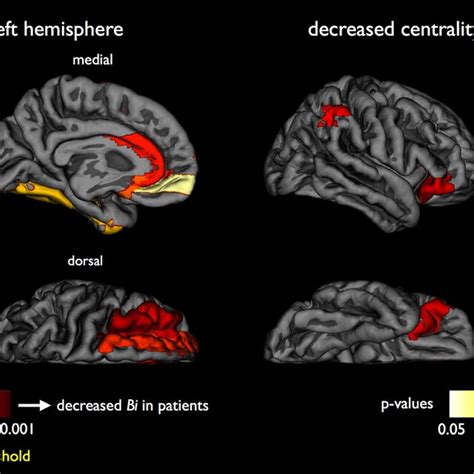 Group Differences Of Node Specific B I Between Healthy Controls And Download Scientific Diagram