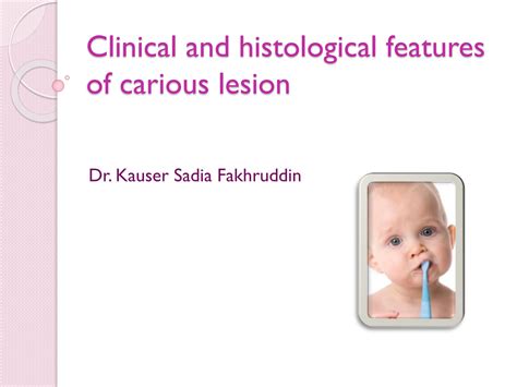 Solution 3 Dcp1 Clinical Histological Features Of Carious Lesion