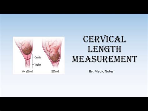 How To Measure Cervical Length Scielo Brasil Assessment Of Length Of