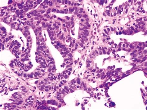 Figure 2 From A Case Of Advanced Intrahepatic Cholangiocarcinoma Successfully Treated With