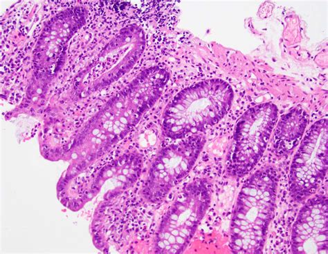 Pathology Outlines Idelalisib Associated
