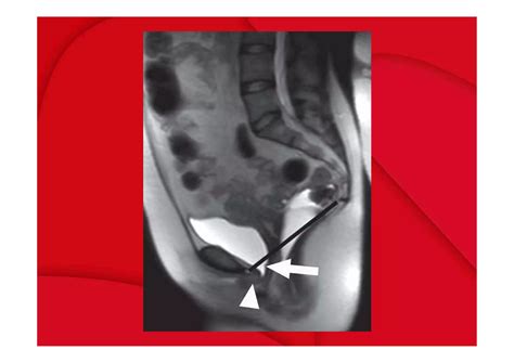 Mri Pelvic Floor Pdf