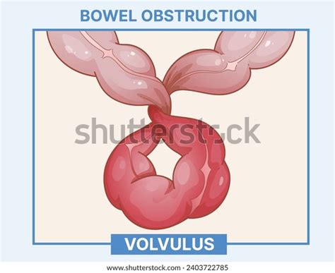 Bowel Obstruction Volvulus Intestine Twists Around Stock Vector