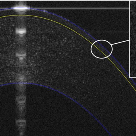 automated segmentation result of corneal anterior posterior and