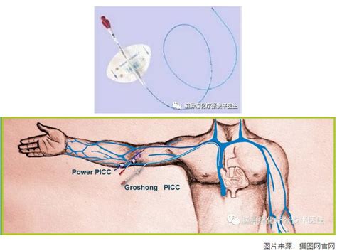 Picc管植入解剖图 千图网