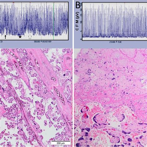 Patterns Of AEEG Recordings A Premature Infants Born Weeks Download Scientific Diagram