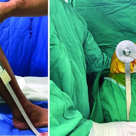 Knee Flexion Angle Kfa Measurement Using A Long Protractor Double Arm Download Scientific