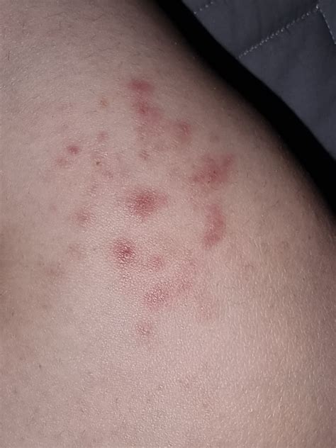 이게 무슨 피부 문제일까요 지식in