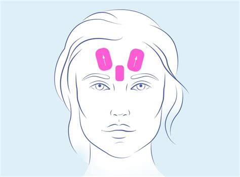 Схема тейпирования лица от морщин на лбу ГАЛТЕЯФАРМ