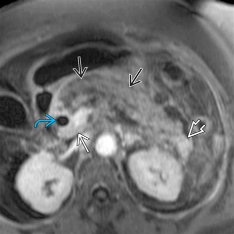 Acute Pancreatitis Radiology Key