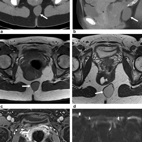 Illustration Of The Anatomy Of The Ischiorectal Fossa Download Scientific Diagram