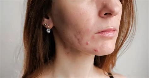 A Comprehensive Guide To Levofloxacin Side Effects