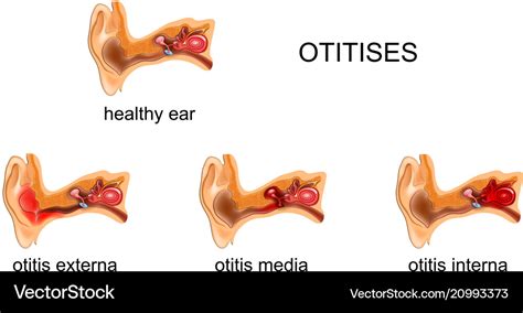 Otitis Externa Vs Otitis Media