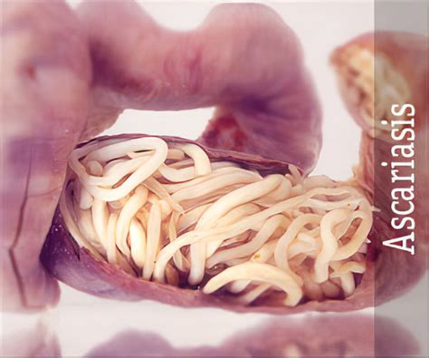 Ascariasis Transmission Clinical Features Management And Prevention