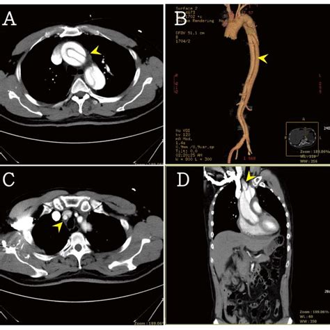 A B Type A Dissection Stanford Classification With Extension To