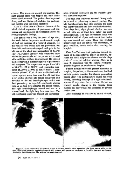 Subphrenic Abscess—roentgen Considerations Pmc