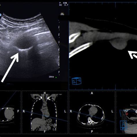 After A Short Z Axis Ct Scan Was Performed In The Area Of Interest