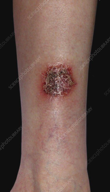Pyoderma Ulcer Stock Image C0482913 Science Photo Library