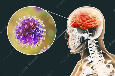 Encephalitis Caused By Nipah Viruses Illustration Stock Image F022