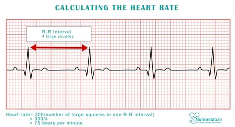 Reading Ecg Made Simple For Nurses Nurseslab Org