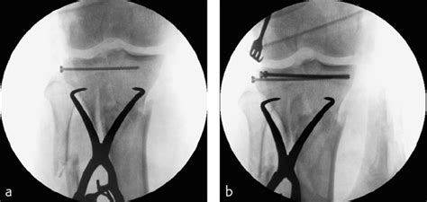 Tibia And Fibula Proximal Metaphyseal Simple Fracture—41 A2 Musculoskeletal Key