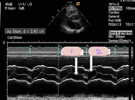 M Mode And Doppler Flashcards Quizlet