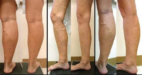 Chicago Vein Care Center Rids Varicose Veins In Chicago