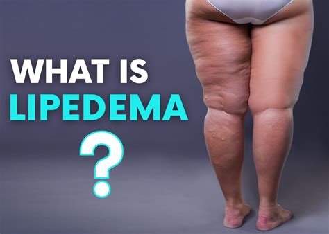What Is Lipedema Symptoms And Treatment Options Turanandturan