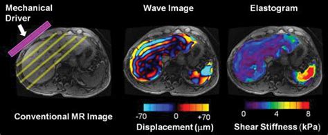 Phase Contrast Mri Physics Techniques And Clinical