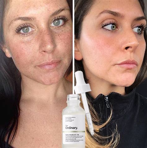 Suero Concentrado Alpha Arbutin 2 Ha Serum Casero Rostro Aceite