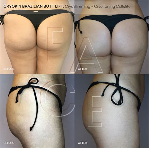 Before And After Brazilian Butt Lift Workout Pics