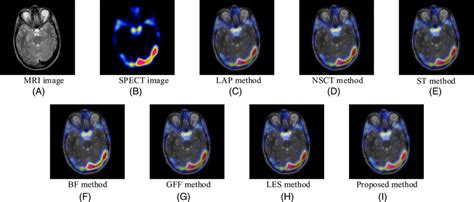 Mri And Spect Source Images And The Fused Images Obtained By Different