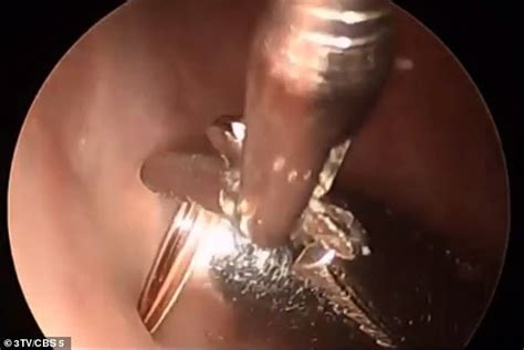 Woman Is Rushed Into Surgery After A Vibrator Gets Stuck In Her BLADDER And It Was Still