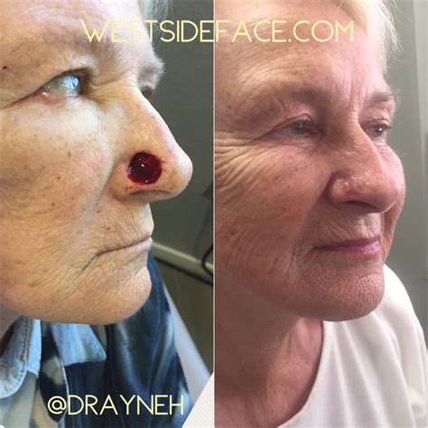 What Does Your Nose Look Like After Mohs Surgery At Armando Mendoza Blog