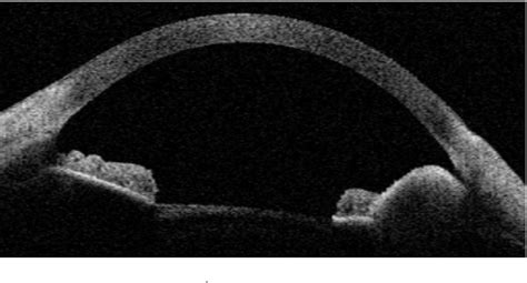 Figure 3 From Evaluation Of Iris Melanoma With Anterior Segment Optical Coherence Tomography