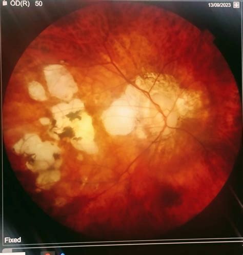 Pathologic Myopia A Subgroup Of Myopia Sudipto Banerjee Posted On The Topic Linkedin