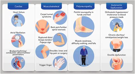 What Is Cardiac Amyloidosis Ultromics