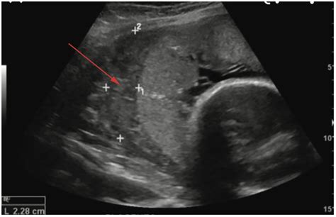 The Main Features Of Placental Abruption Clinical Presentation And